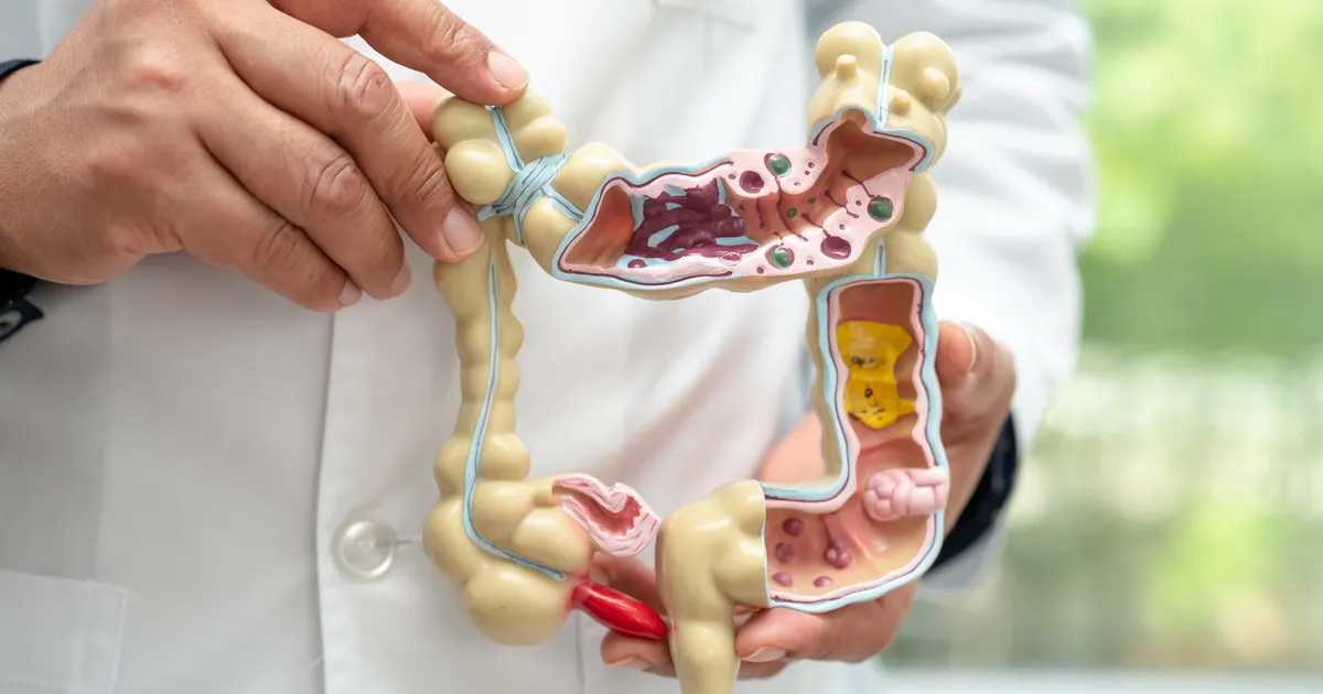 Numărul persoanelor sub 50 de ani cu cancer intestinal, în creștere ...